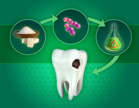 The Stages of Tooth Decay: Everything You Need to Know - Patient ...