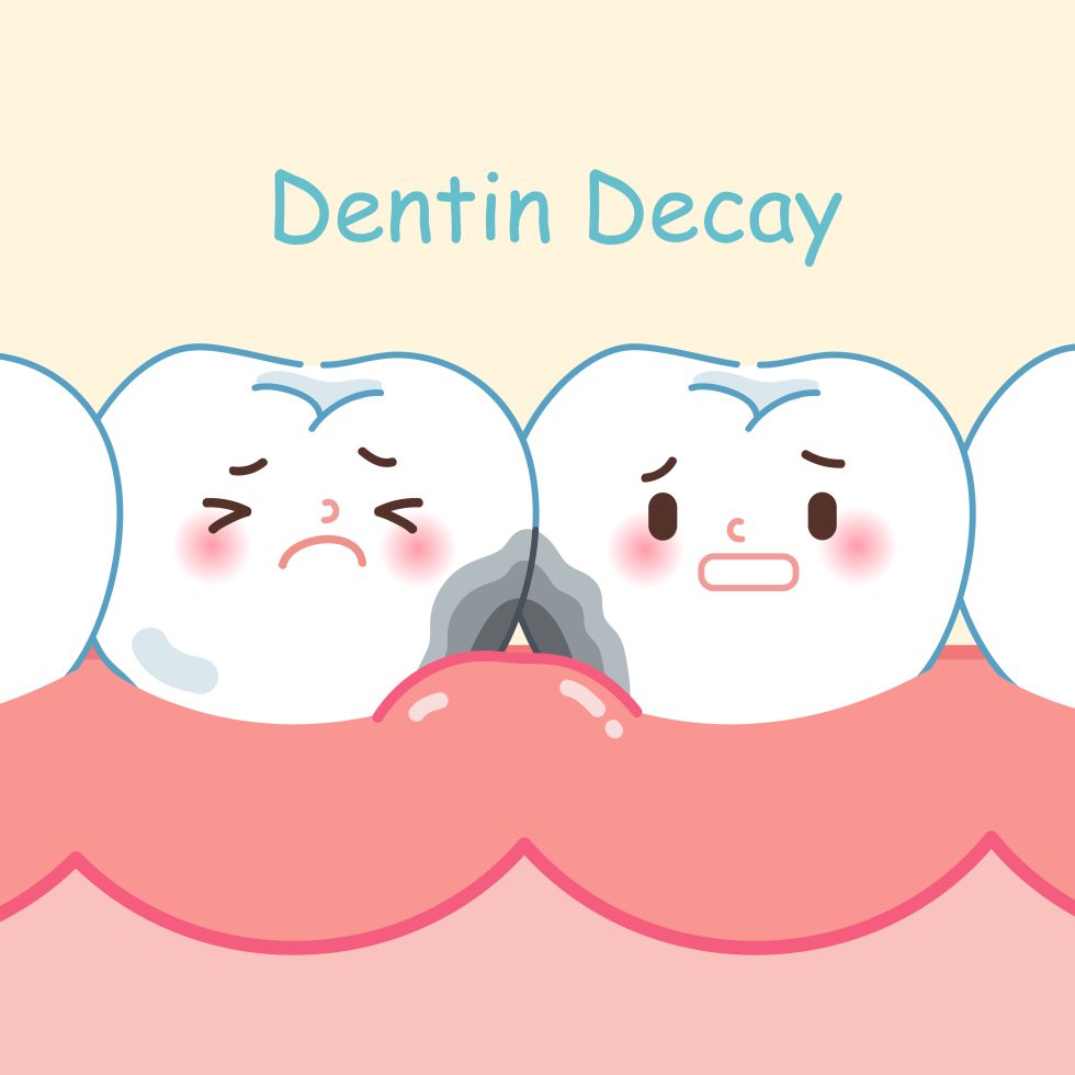 The Stages of Tooth Decay: Everything You Need to Know - Patient ...