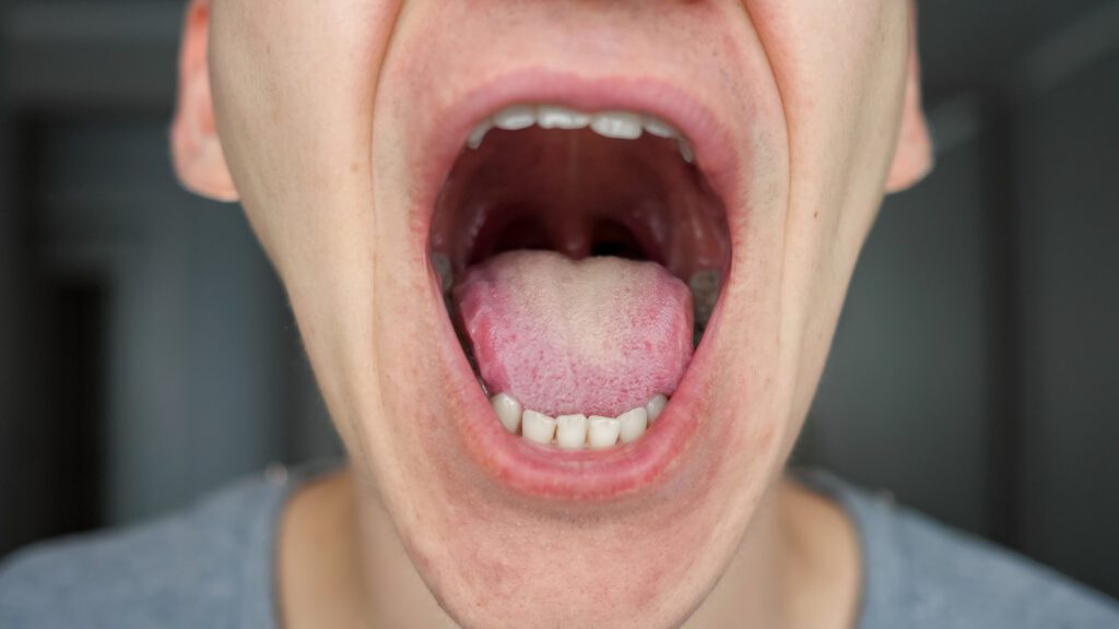 Everything You Need To Know About White Spots On The Tongue Patient