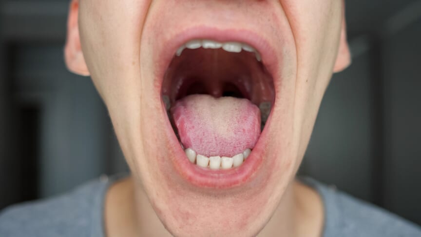 Everything You Need To Know About White Spots On The Tongue Patient