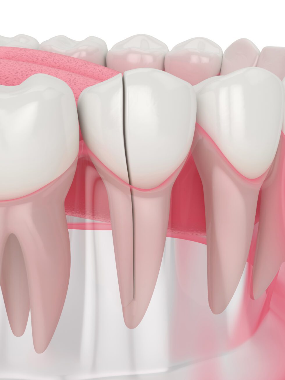 Splitting Teeth: A Friendly Guide to Understanding and Preventing Tooth ...