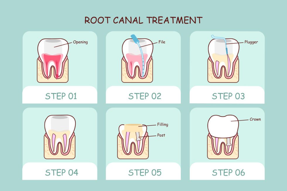 Understanding Gum Abscesses: A Comprehensive Guide - Patient Empowered ...