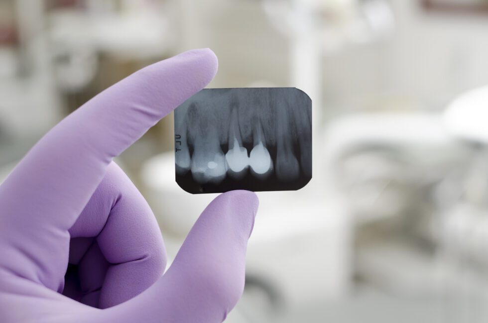 Understanding Gum Abscesses: A Comprehensive Guide - Patient Empowered ...